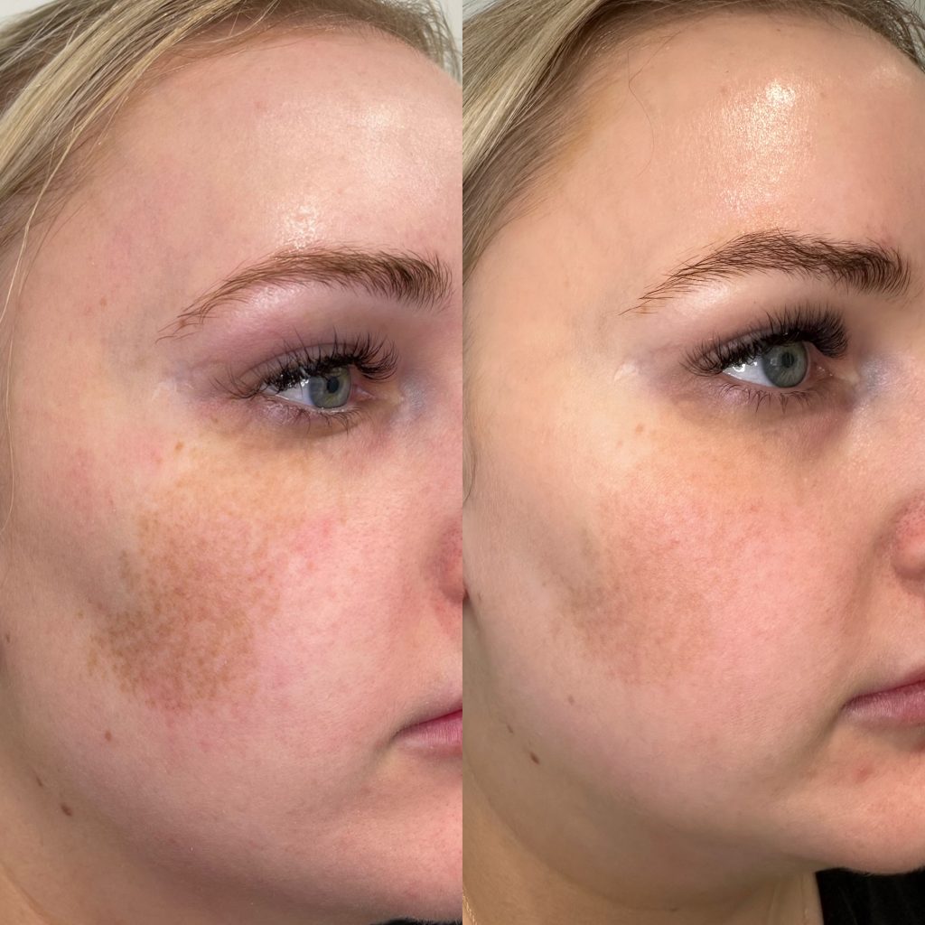 Cosmelan® Evo Depigmentation Treatment | Clear Skincare