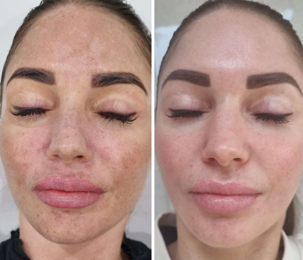 Cosmelan® Evo Depigmentation Treatment | Clear Skincare