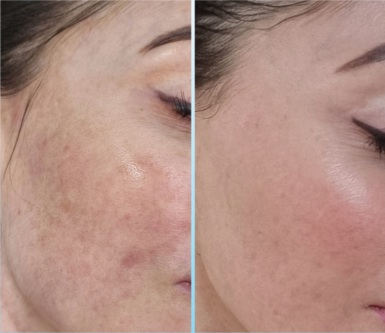 Cosmelan® Evo Depigmentation Treatment | Clear Skincare