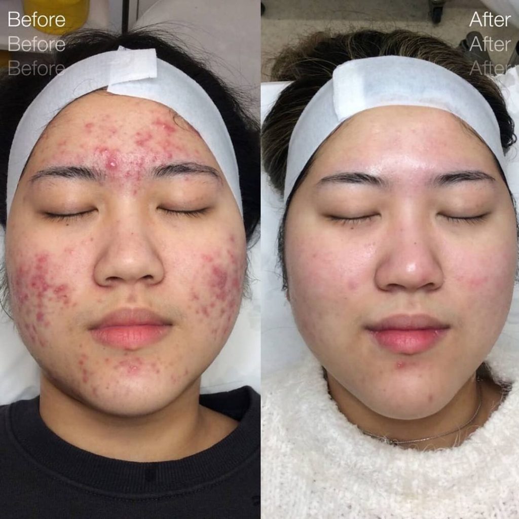 Signature Acne Treatment | Clear Skincare