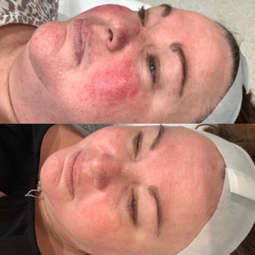 Laser for Redness + Rosacea – Clear Skincare