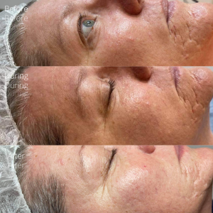 Microneedling – Resurface & Renew Your Skin | Clear Skincare