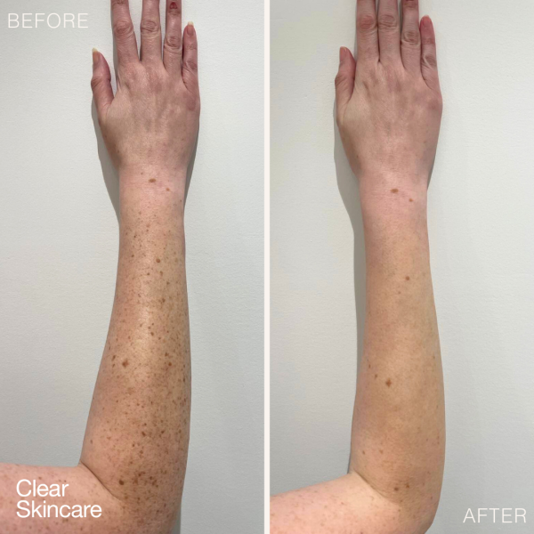 Laser Pigmentation Removal | Clear Skincare