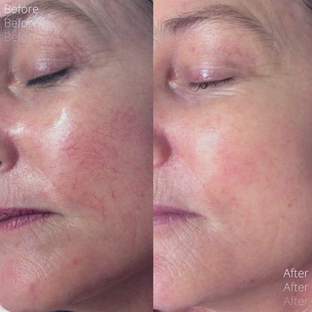 Red Vein, Cherry Angioma & Skin Tag Removal | Clear Skincare