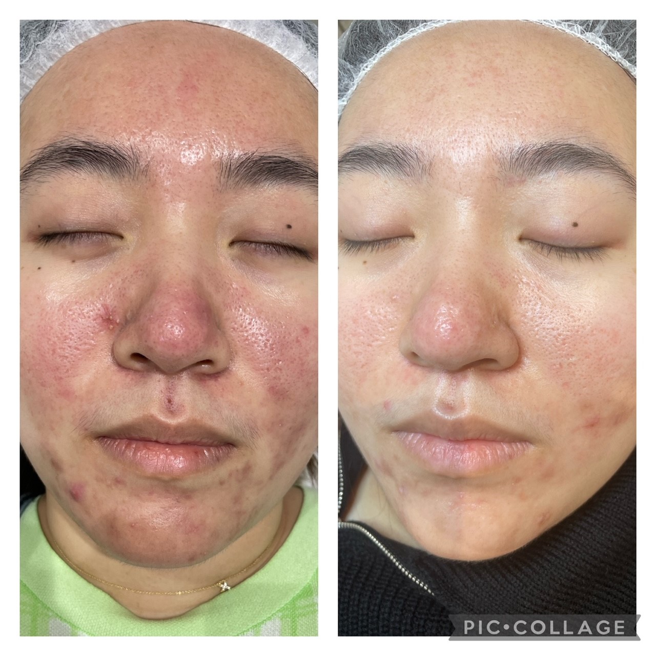 Lumixa Skin Treatment – Target Signs of Ageing | Clear Skincare