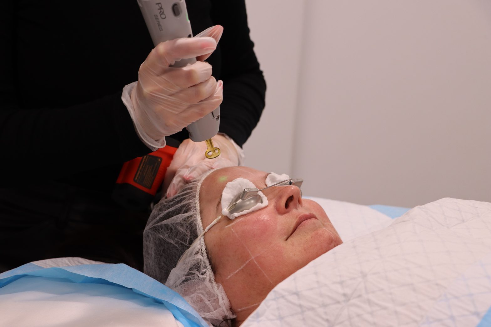 Laser for Redness + Rosacea | Clear Skincare